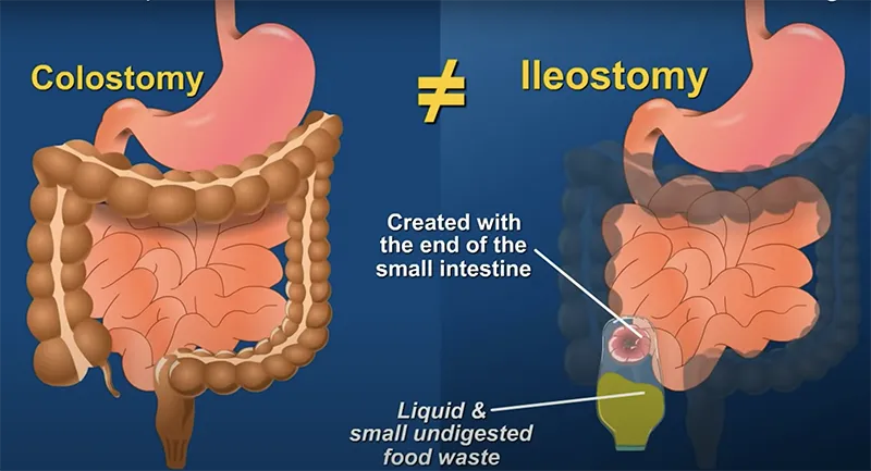 Stoma Care: Functionalize Your Body With OWC