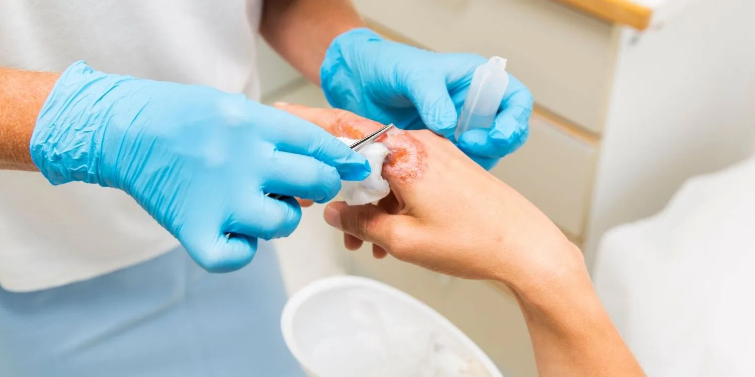 What to Know About Fungal Wound Infections - OWC Center