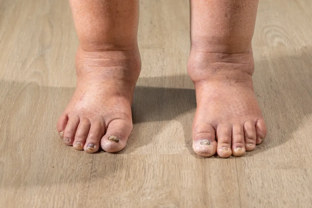 How Lymphedema Affects Wound Healing and Ways to Manage It