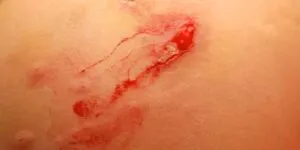 What to Know About Fungal Wound Infections - OWC Center