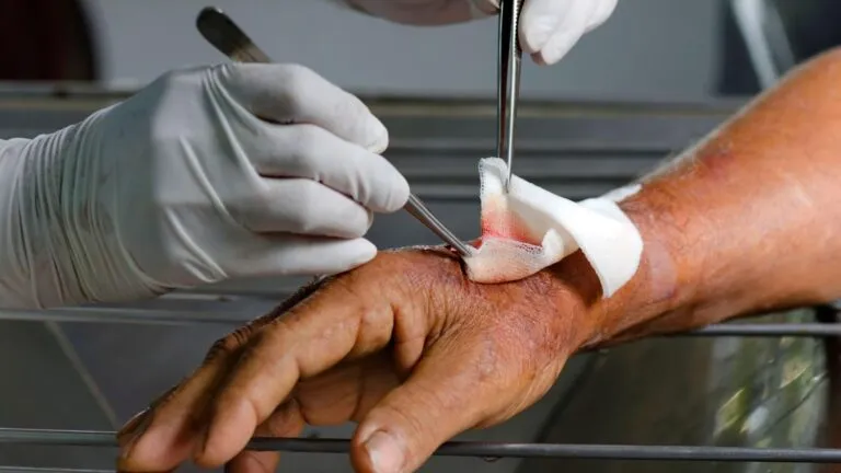 How to Address Odor and Drainage from Chronic Wounds